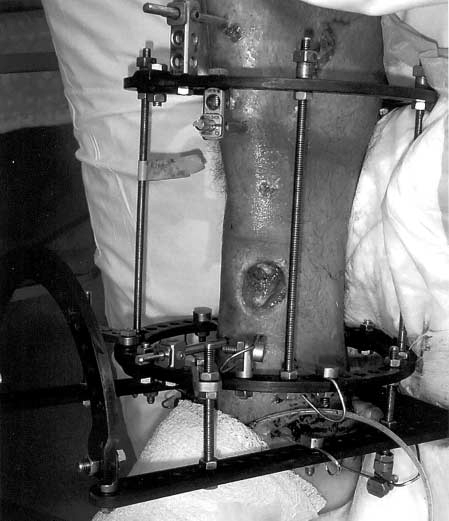 Ilizarov External Fixator for Bone Healing and Soft Tissue Closure on ...