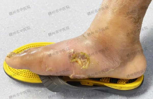 Operation Case:CareFix Transverse Tibial Bone Transport – MLifer Ortho