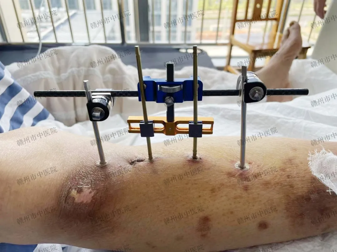 Operation Case:CareFix Transverse Tibial Bone Transport – MLifer Ortho