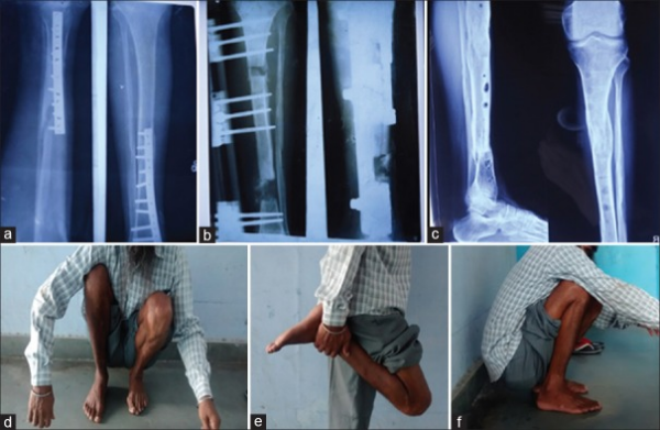 Understanding Nonunion of Long Bone Fractures & How to Choose Between ...